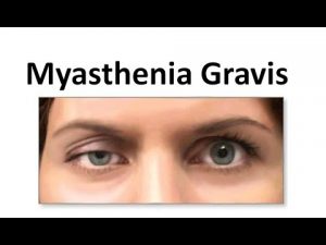 A case of Myasthenia Gravis diagnosed with an Ice Pack: NEJM case report