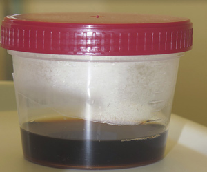 A case of Diffuse Melanosis and Melanuria