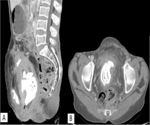 Dead fetus in uterus for 20 years, develops into lithopedion: Rare ...